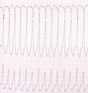 Ventricular Tachycardia (VT) - All About Heart And Blood Vessels