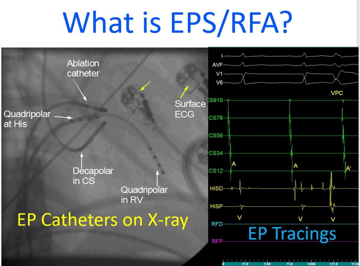 What Is EPS RFA All About Heart And Blood Vessels What Is EPS RFA All About Heart And Blood Vessels