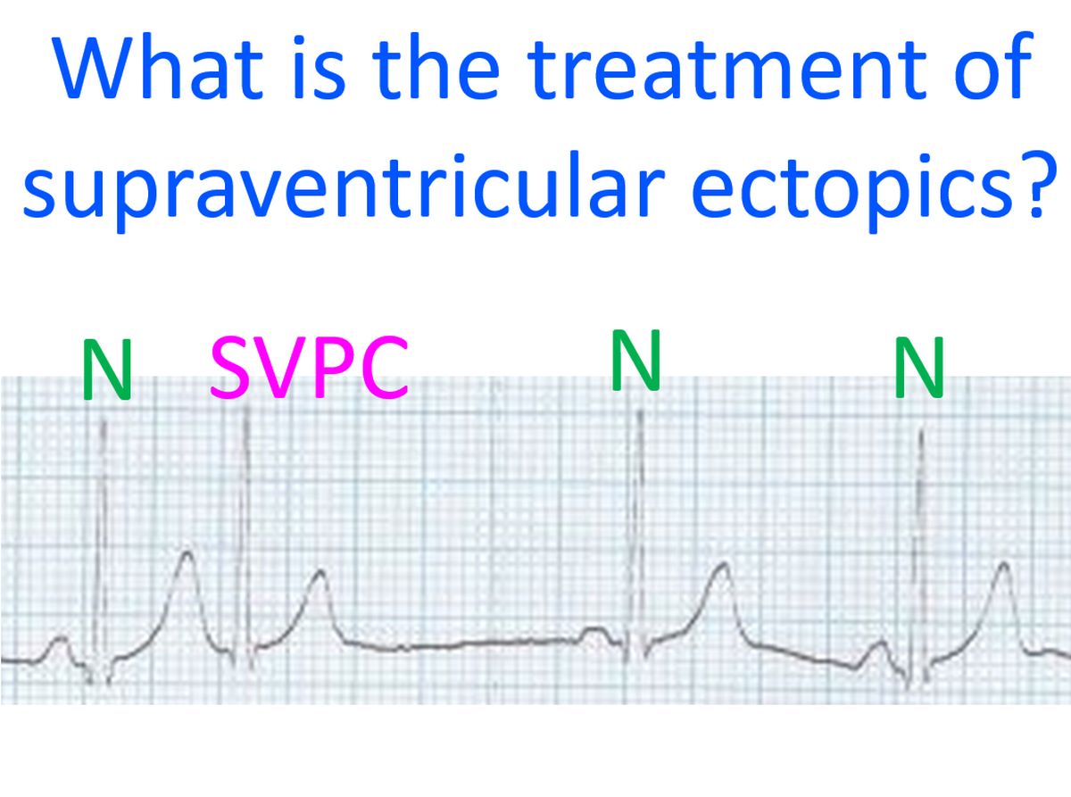 What Is The Treatment Of Supraventricular Ectopics All About Heart