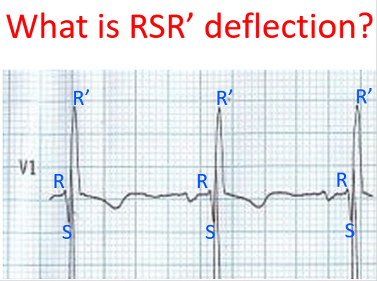 What Is RSR Deflection All About Heart And Blood Vessels What Is RSR Deflection All About Heart And Blood Vessels