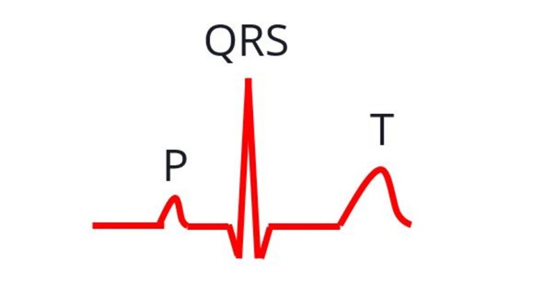 Simplified explanation of ECG changes in a heart attack - All About ...