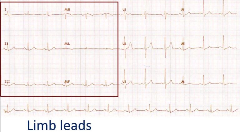 What is an ECG? - All About Heart And Blood Vessels