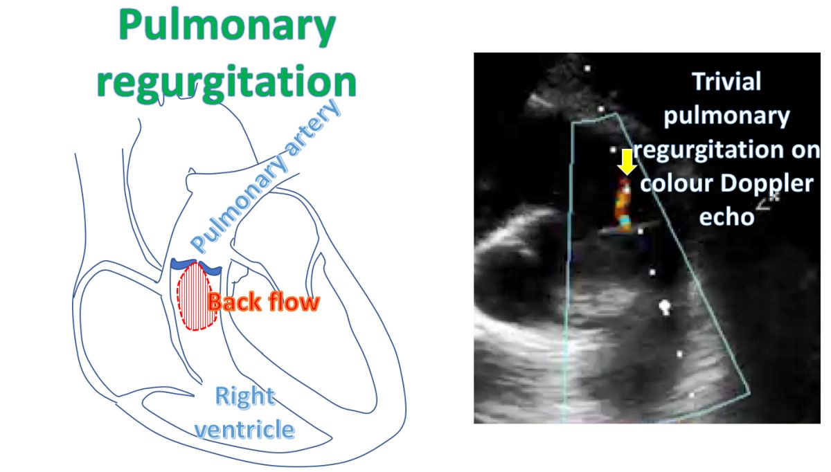 What is pulmonary regurgitation? - All About Heart And Blood Vessels