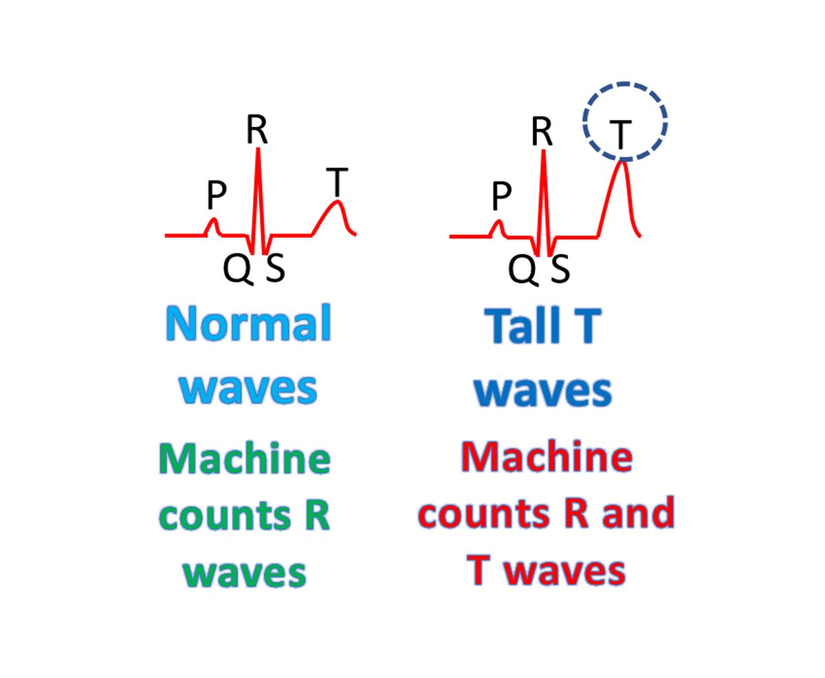 How to check heart rate from the ECG? - All About Heart And Blood Vessels