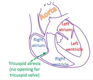 What is a bidirectional Glenn procedure (BDG)? - All About Heart And ...