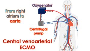 What is ECMO? - All About Heart And Blood Vessels