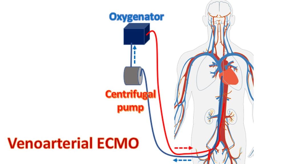 What is ECMO? - All About Heart And Blood Vessels