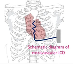 Extravascular ICD - New medical device - All About Heart And Blood Vessels