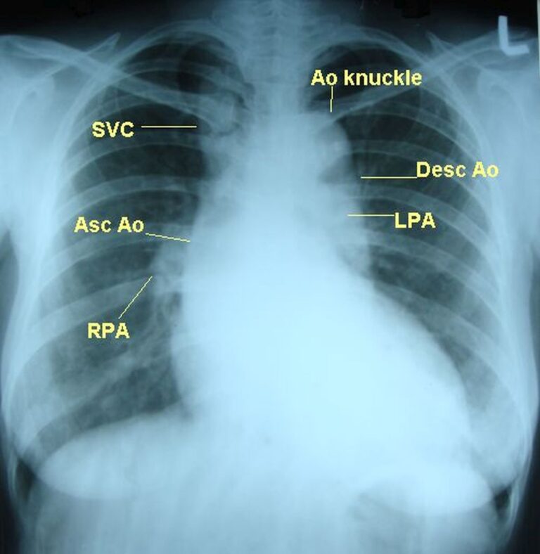 What is unfolded aorta? - All About Heart And Blood Vessels