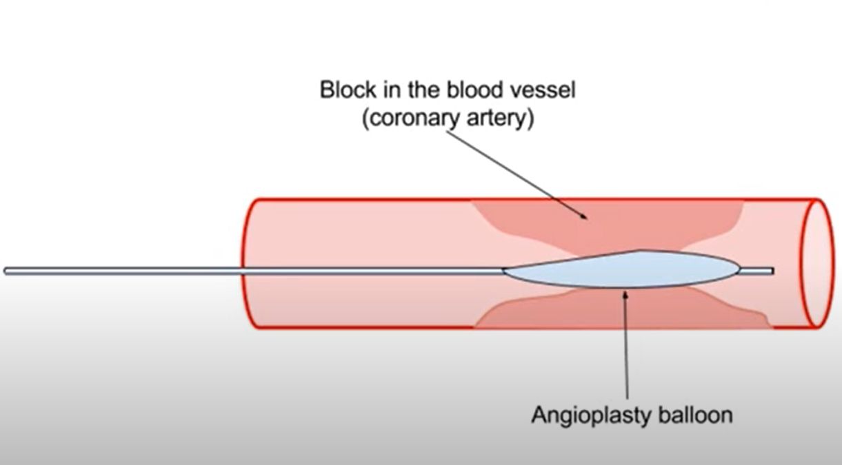 Coronary Angioplasty: Removal of Blocks - All About Heart And Blood Vessels