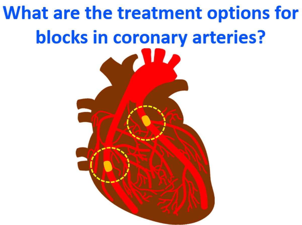 What are the treatment options for blocks in coronary arteries? - All ...
