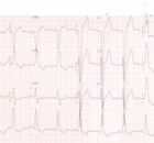 Left Bundle Branch Block (LBBB) and STEMI criteria - All About ...