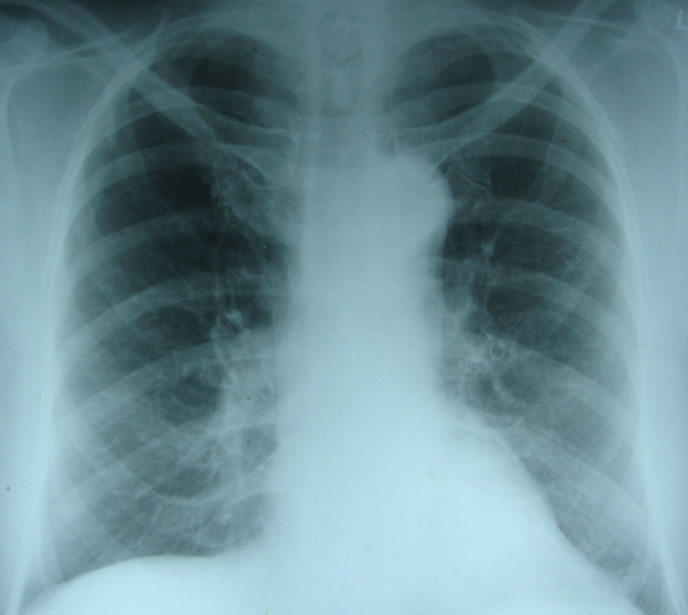 Pulmonary Edema X ray Chest PA View All About Cardiovascular System