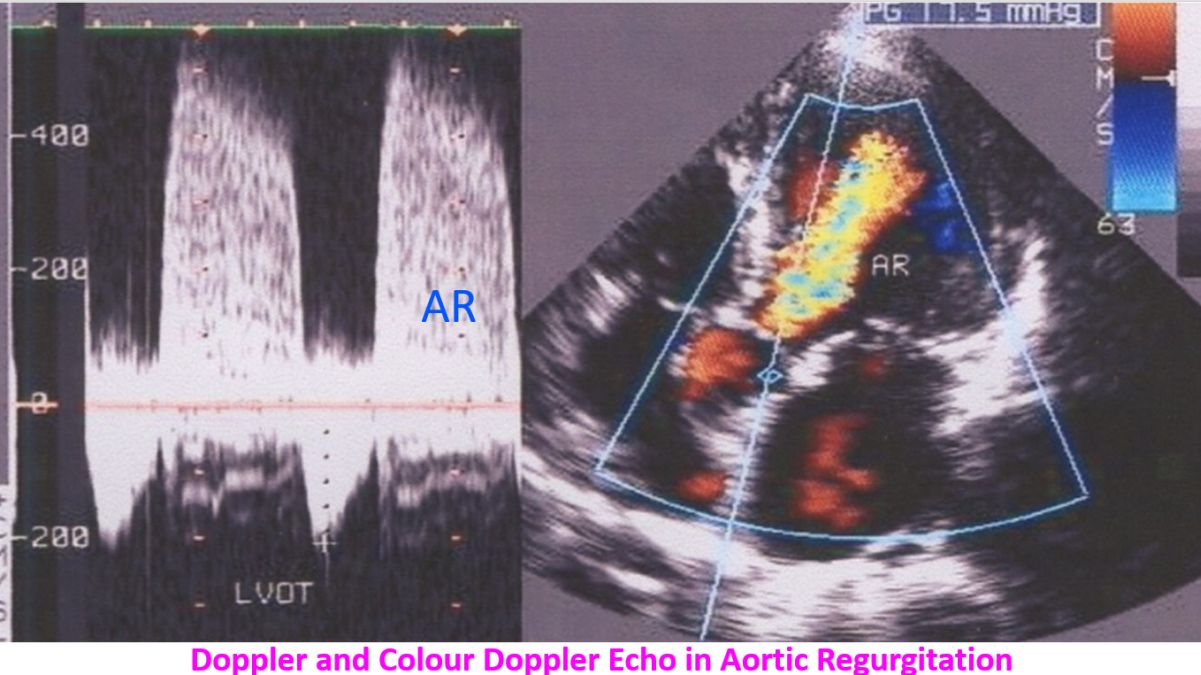 Aortic Regurgitation AR Leakage Of The Aortic Valve