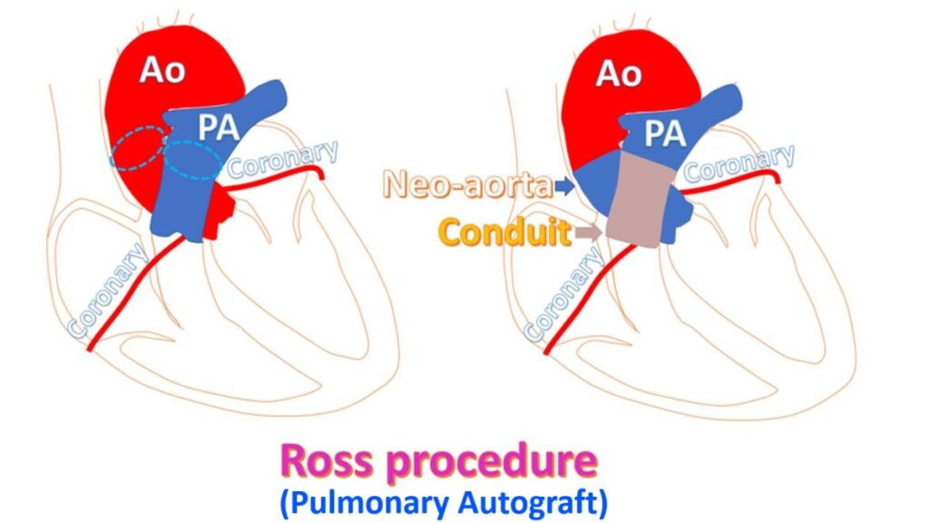 Aortic Regurgitation (AR) - leakage of the aortic valve