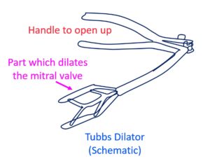 Closed heart surgery for mitral stenosis (closed mitral valvotomy ...