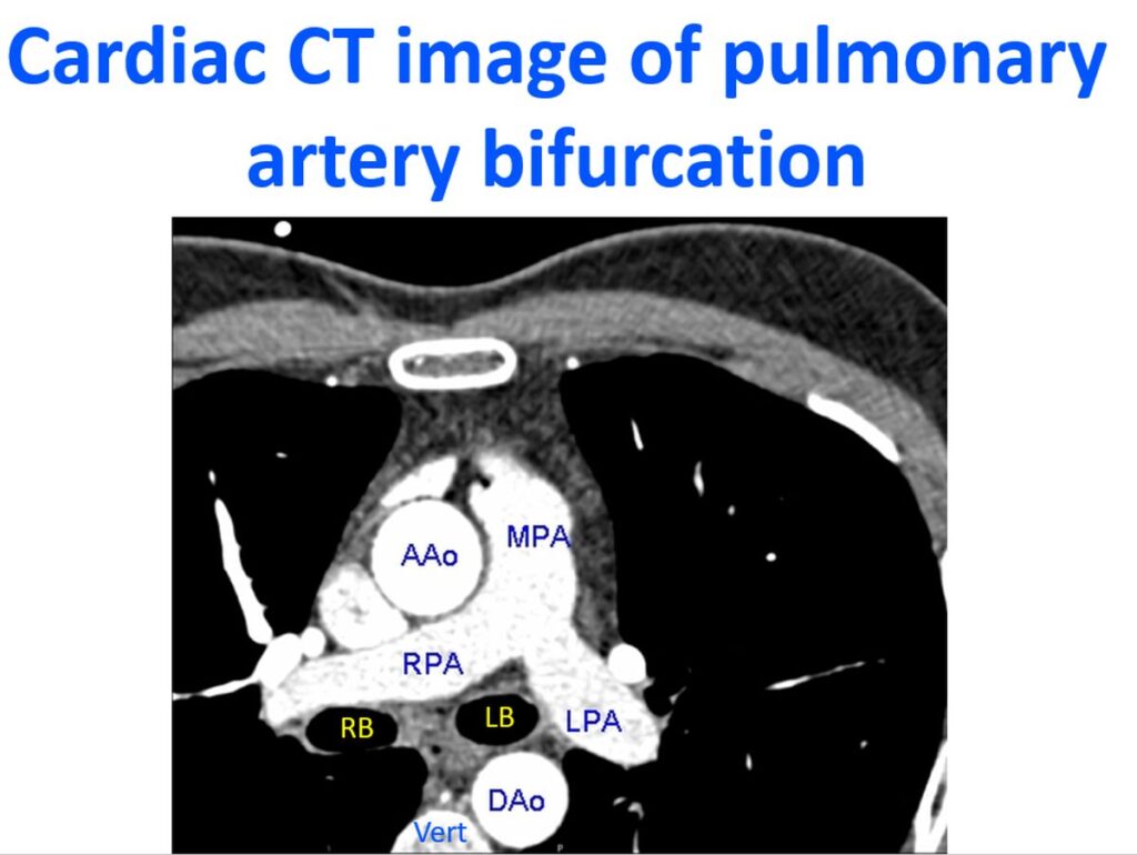 Cardiac CT image of pulmonary artery bifurcation - All About ...