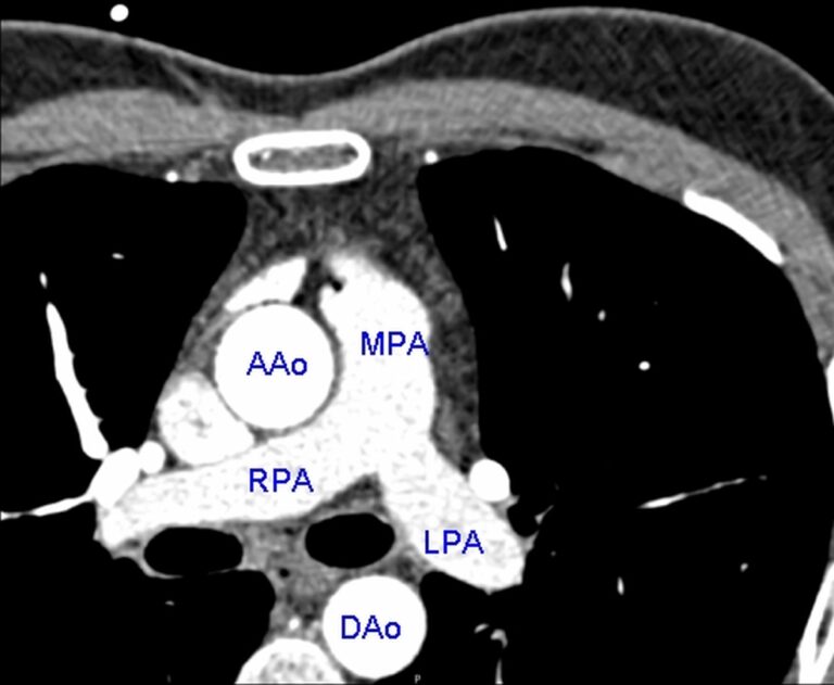 Cardiac Ct Image Of Pulmonary Artery Bifurcation