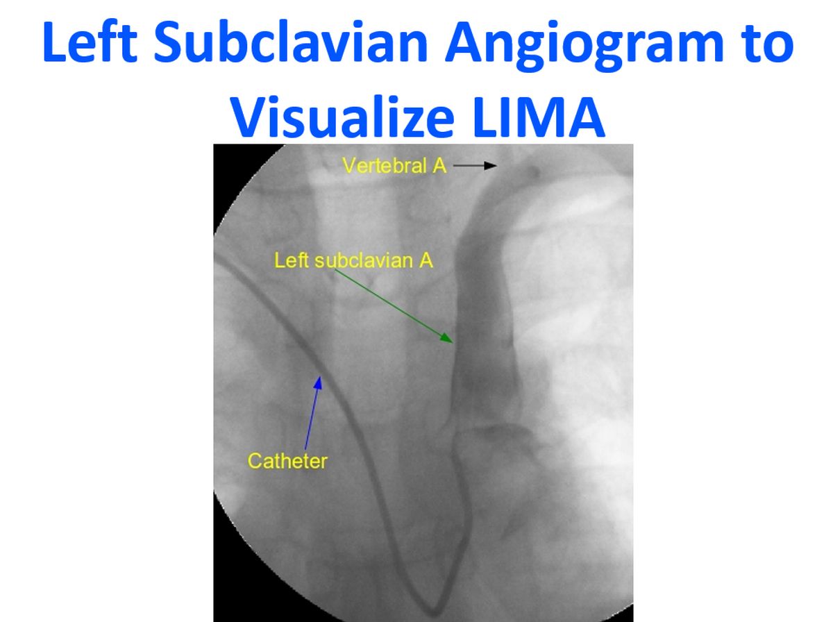Left subclavian angiogram to visualise LIMA - All About Cardiovascular ...