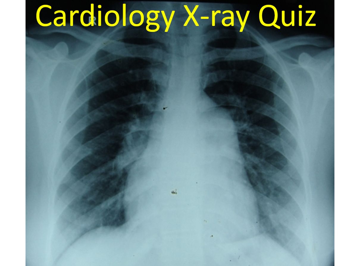 Cardiology X-ray Quiz - All About Cardiovascular System and Disorders