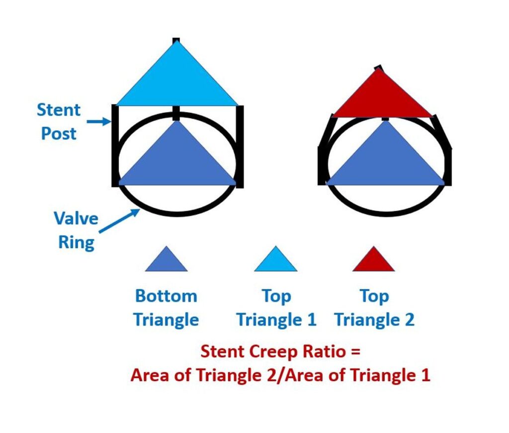 Prosthetic valve degeneration and stent creep (inward bending of struts)