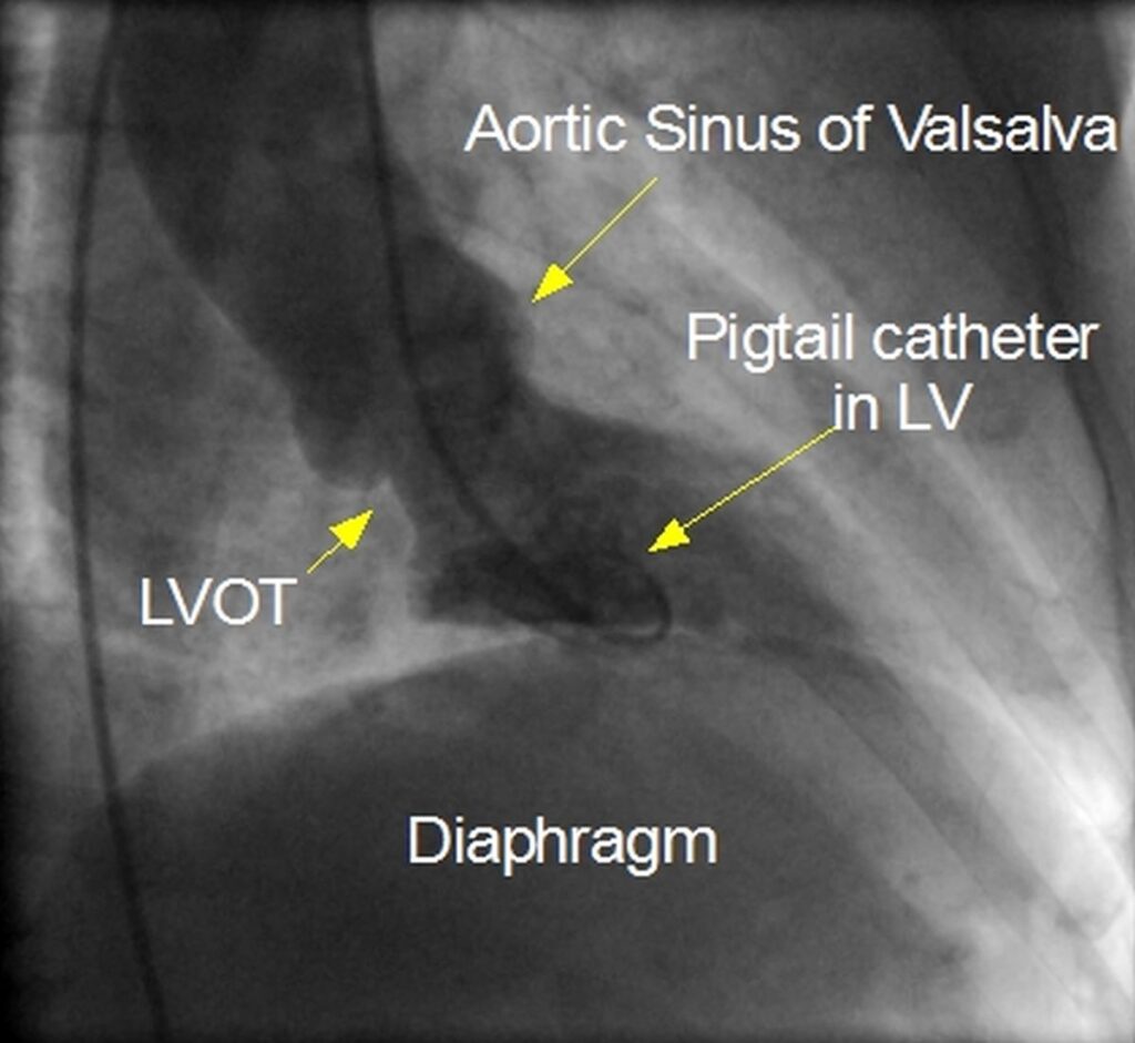 Left ventricular angiogram in right anterior oblique view