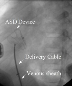 Device closure of atrial septal defect (ASD) - description