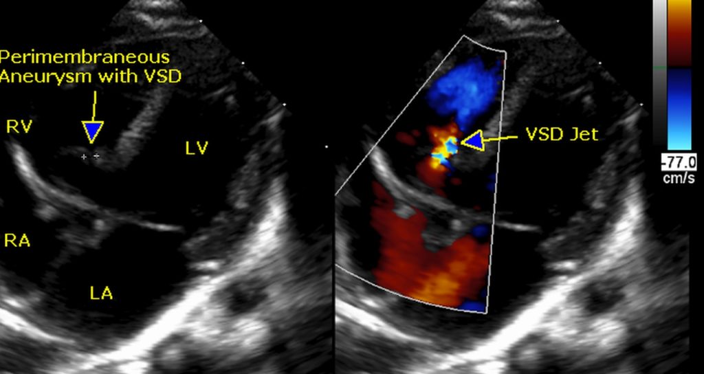 Echocardiogram In Ventricular Septal Defect Plax And Apical 4c Views