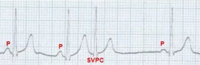 Supraventricular Arrhythmia Part 1 