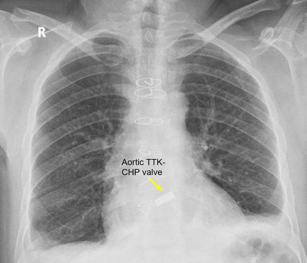 X Valve Aortic X Valve Aortic