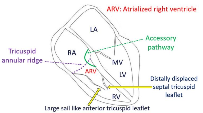 Arrhythmias in Ebstein's anomaly - All About Cardiovascular System and ...