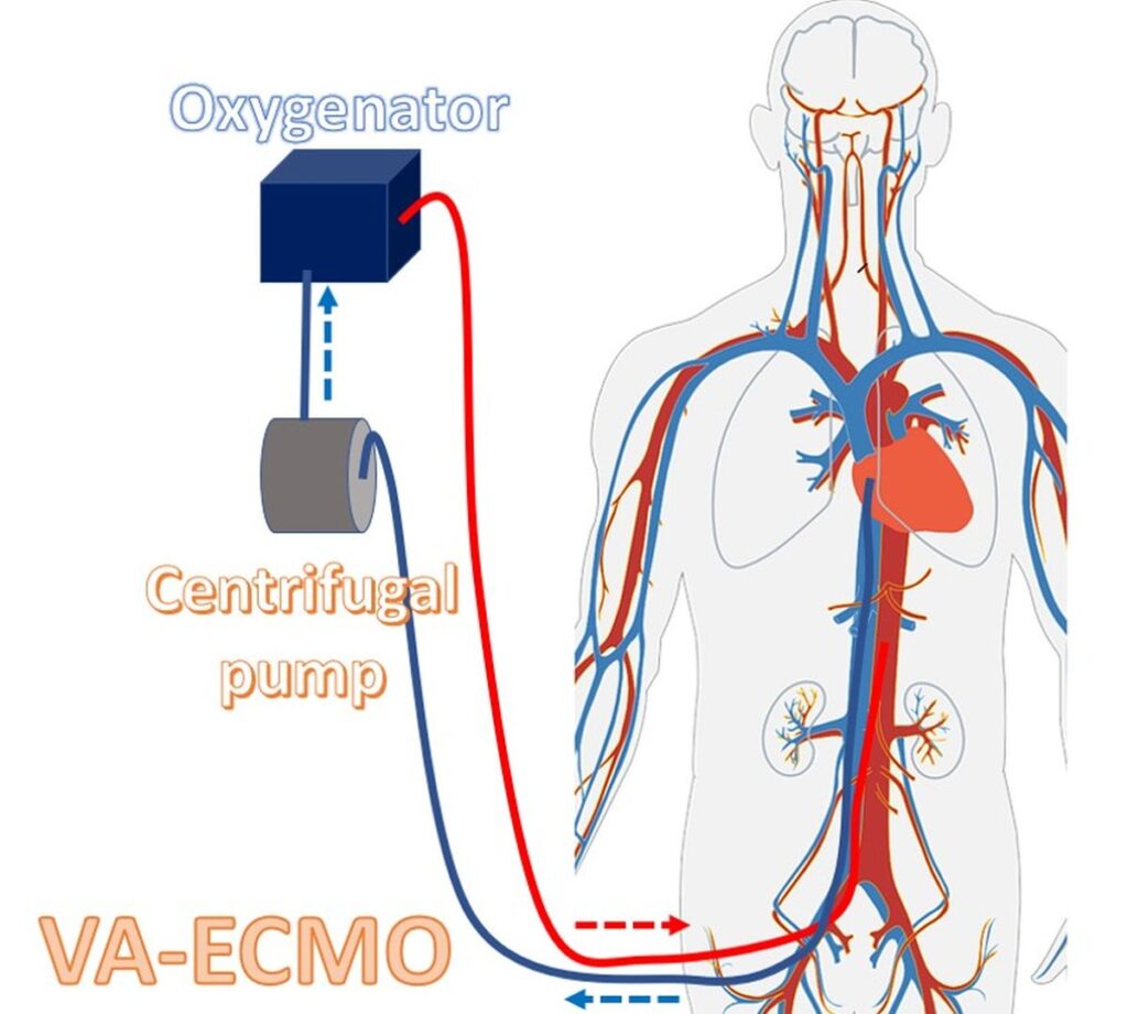Arterial switch operation (Jatene procedure) - All About Cardiovascular ...
