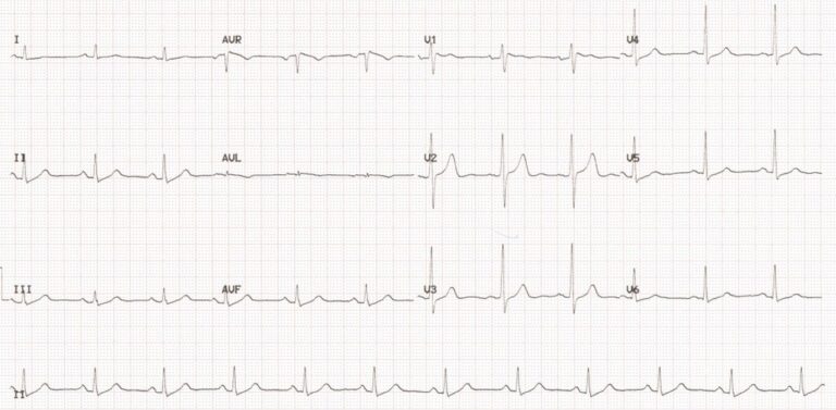 12 lead ECG