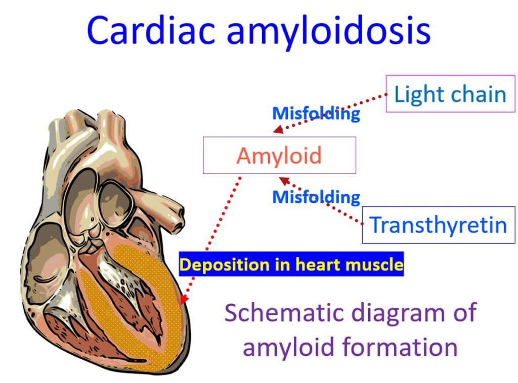 Cardiac amyloidosis - All About Cardiovascular System and Disorders