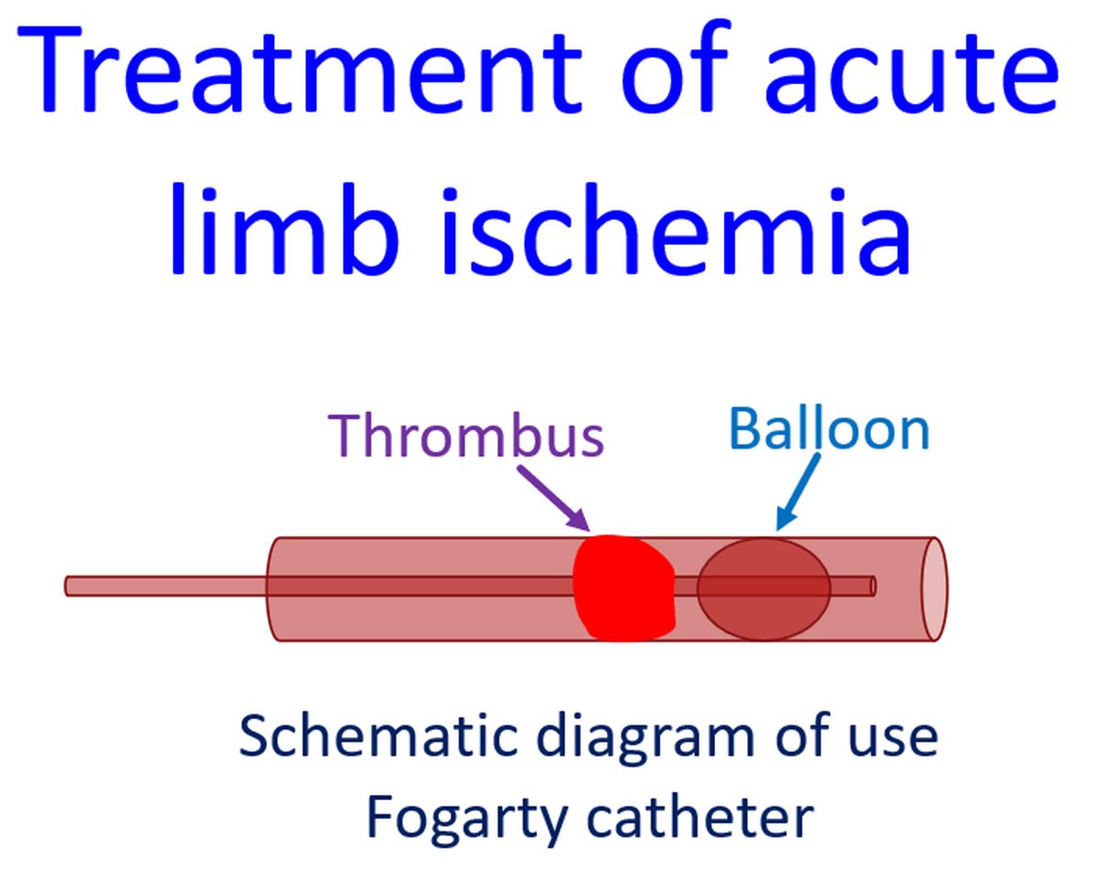 Treatment of acute limb ischemia - All About Cardiovascular System and ...