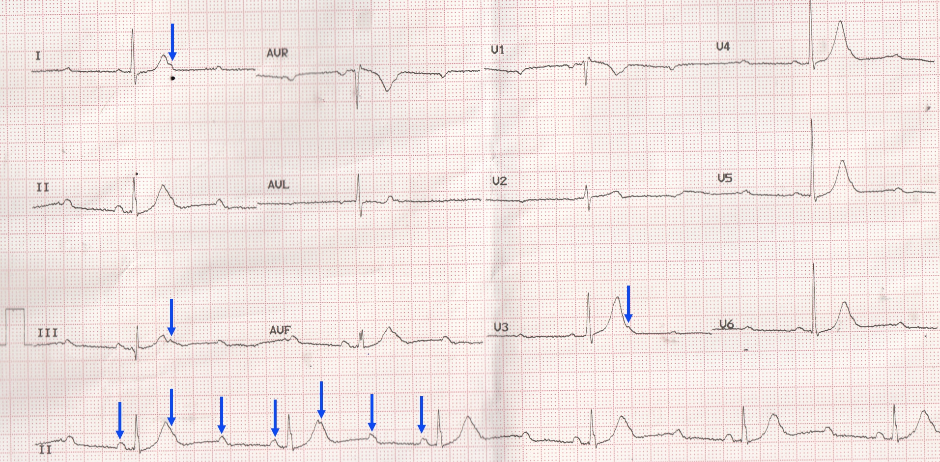 ECG Showing 3:1 AV Block - All About Cardiovascular System and Disorders