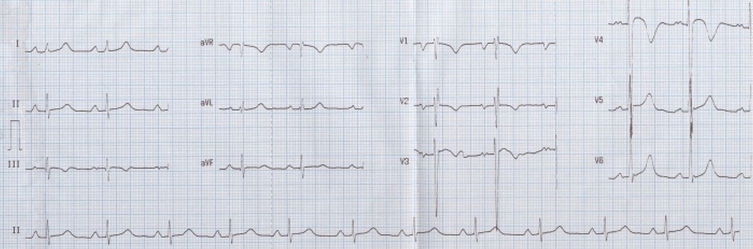 Collection of a few ECGs in congenital heart diseases - All About ...