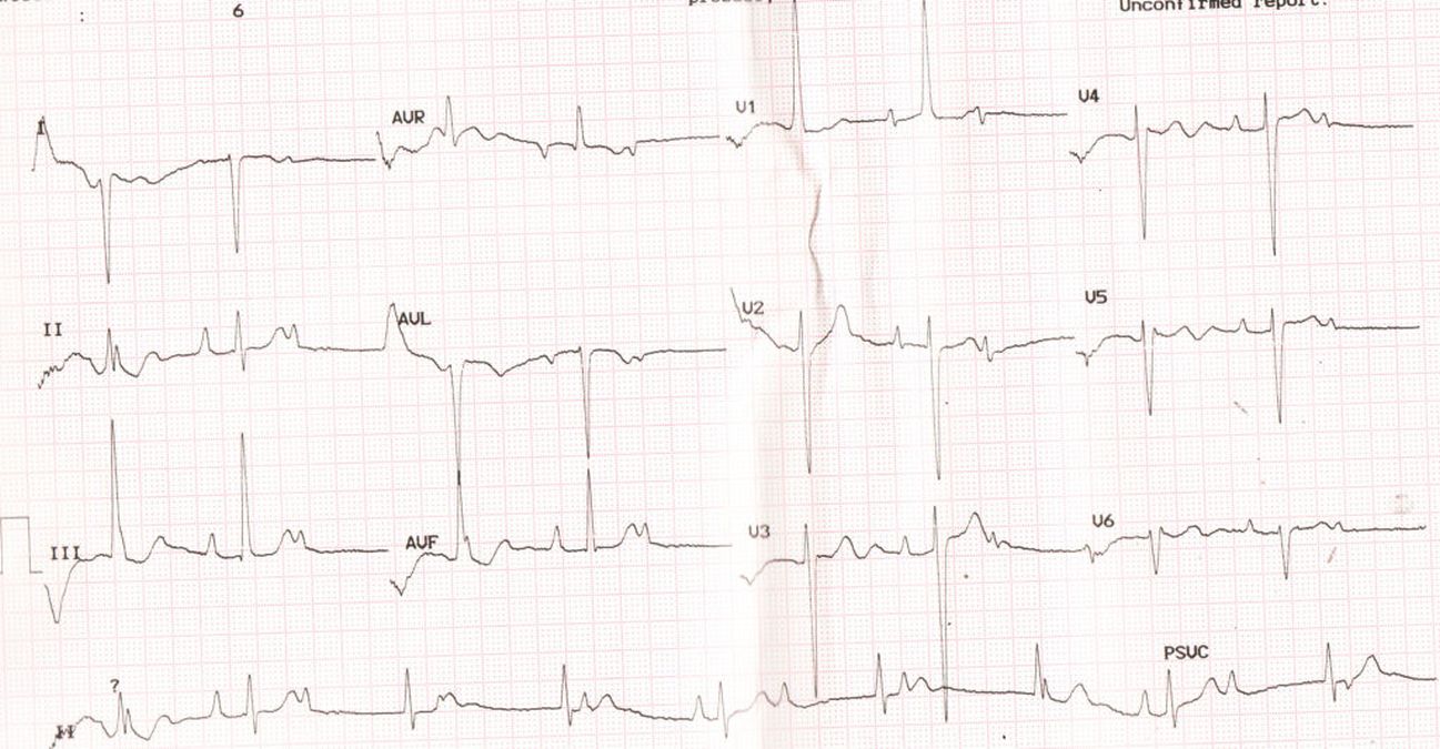 Complete heart block and right ventricular hypertrophy - All About ...