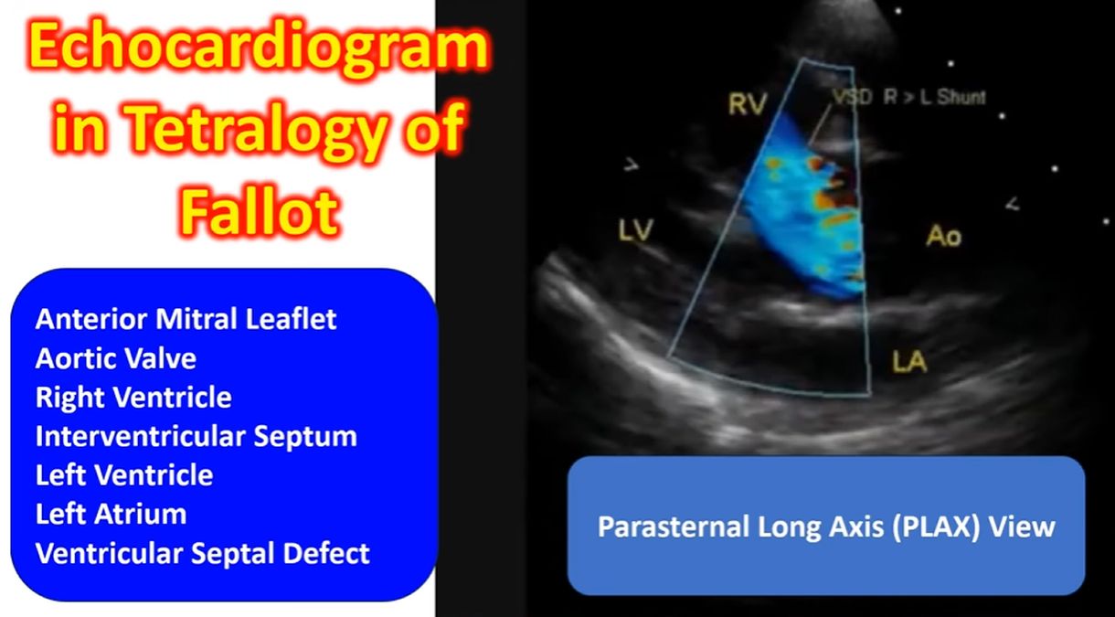 Echocardiogram in Tetralogy of Fallot - All About Cardiovascular System ...