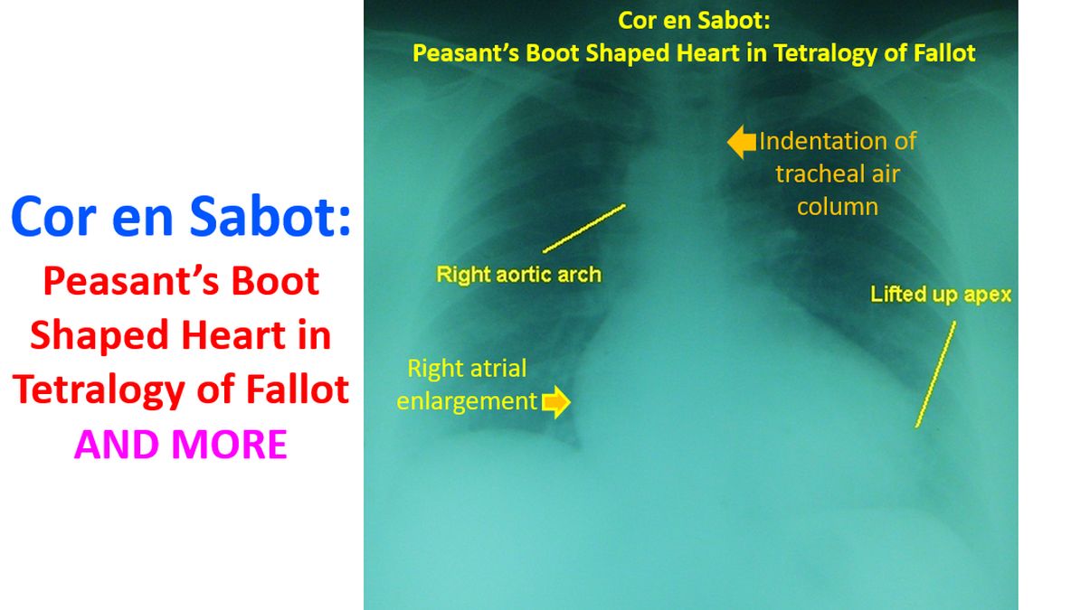 Cor en Sabot: Peasant’s Boot Shaped Heart in Tetralogy of Fallot AND ...