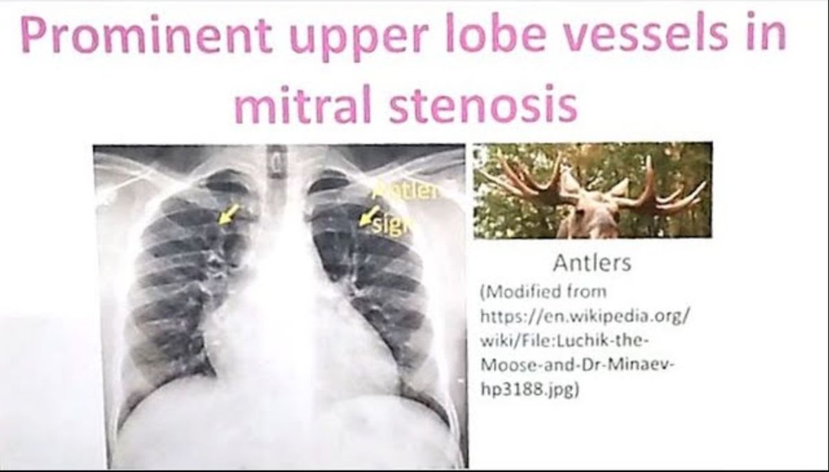 Prominent upper lobe vessels on chest X-ray in mitral stenosis - All ...