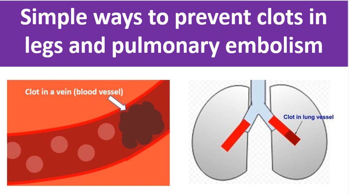 Simple ways to prevent clots in legs and pulmonary embolism - All About ...