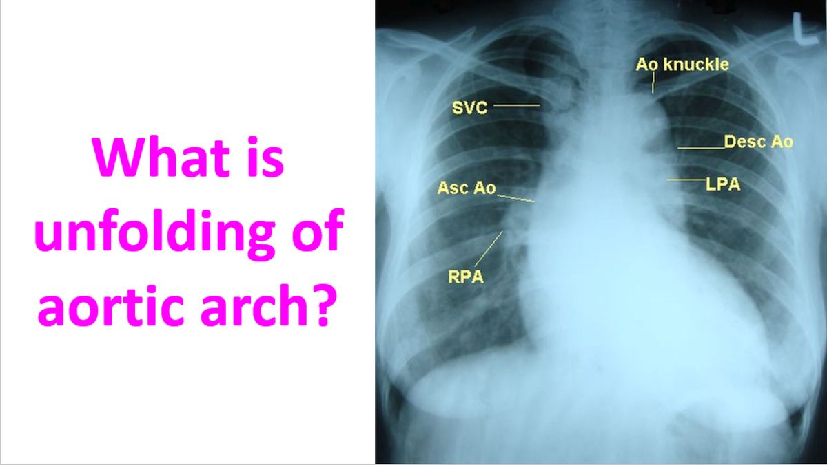 What is unfolding of aortic arch? - All About Cardiovascular System and ...