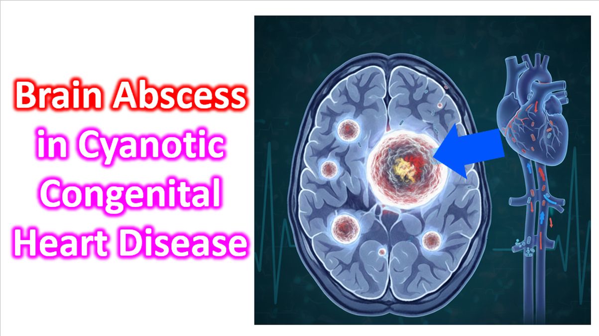 Brain abscess in Cyanotic Congenital Heart Disease - All About ...