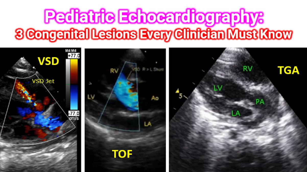 Pediatric Echocardiography: 3 Congenital Lesions Every Clinician Must ...
