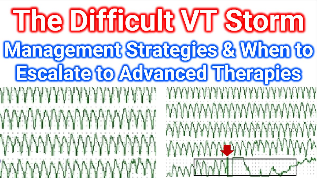 The Difficult VT Storm: Management Strategies & When to Escalate to ...