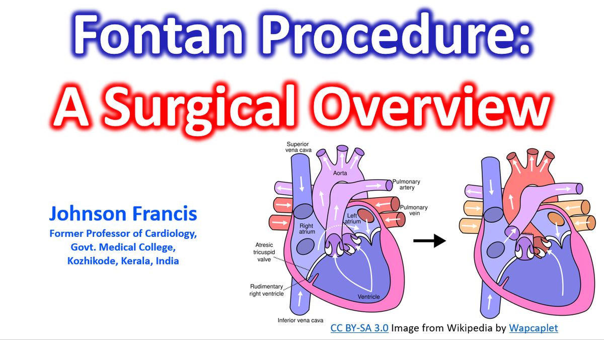 Fontan Procedure: A Surgical Overview - All About Cardiovascular System ...